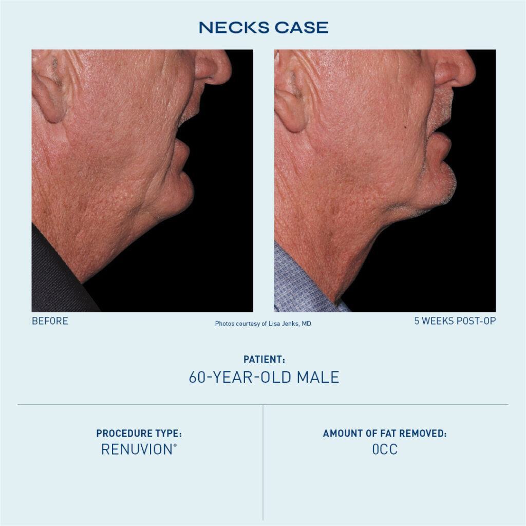 Renuvion (Neck) - Matthew H. Steele, MD